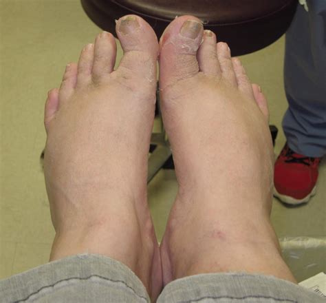Treating Metatarsus Adductus Deformity In A Patient With Uncontrolled Diabetic Neuropathy