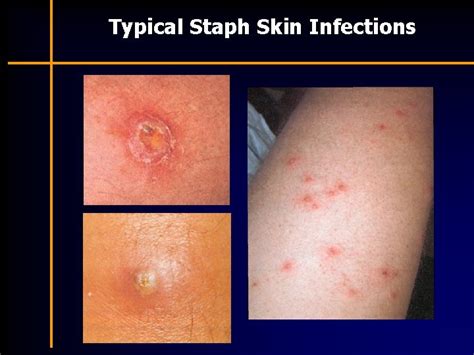 Staphylococcus Aureus Skin Infections Typical Staph Skin Infections