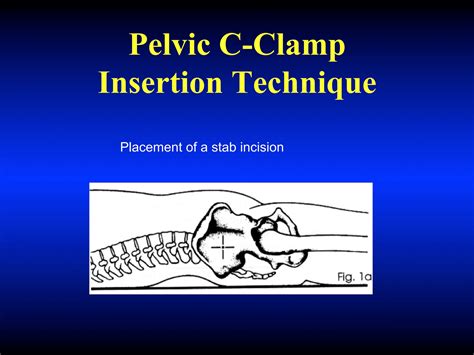 Pelvis Fracture Pdf