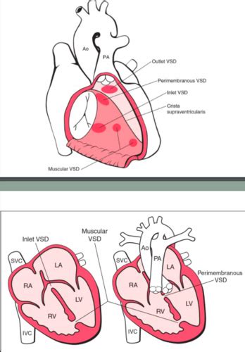 Chd Ventricular Septal Defect Flashcards Quizlet