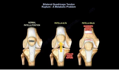 Bilateral Quadriceps Tendon Rupture —