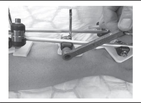 Figure 1 From Use Of A Femoral Impaction Grafting System In Revision Total Elbow Arthroplasty