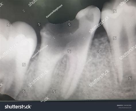 Molar Cavity Xray At Shirley Arrowood Blog