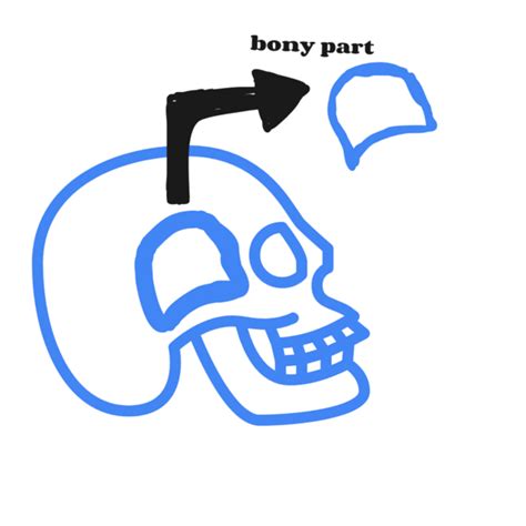 Decompressive Craniectomy Dc Physiopedia