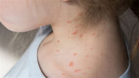 Внимание Отчитат бум на варицела в Монтанско