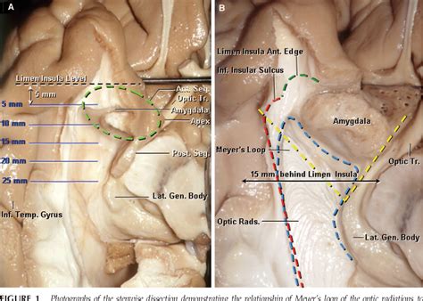 Figure 1 From Meyers Loop And The Optic Radiations In The Transsylvian Approach To The