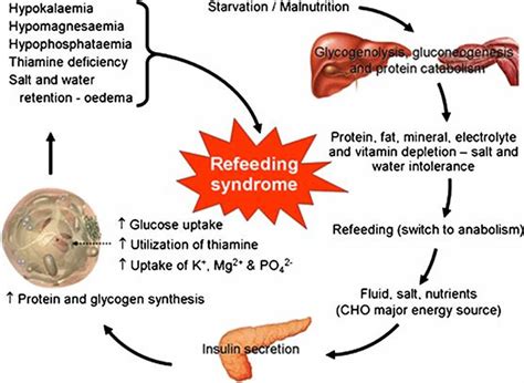 Refeeding Syndrome Causes Symptoms Diagnosis And Treatment