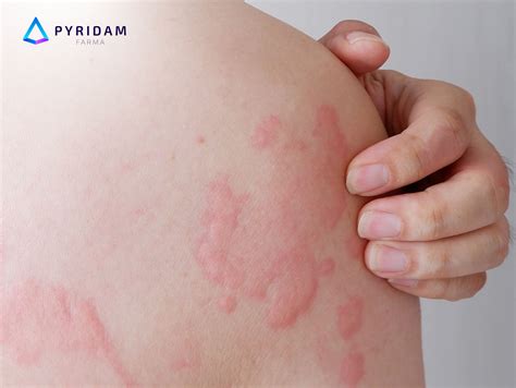 6 Cara Mengobati Kaligata Minum Obat Hingga Hindari Stres