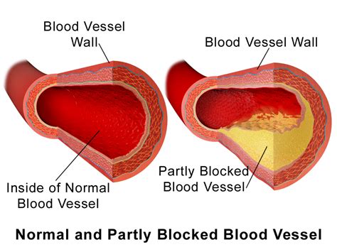 Cholesterin Und Arteriosklerose Potanana