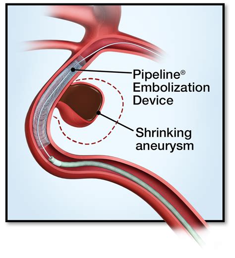 3013 Sentara Aneurysm