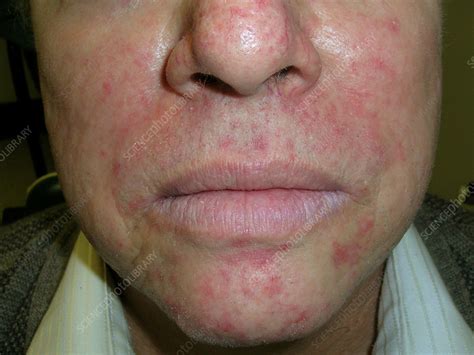 Dermatitis Stock Image C056 4951 Science Photo Library