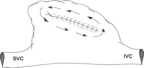 Surgeons View Of The Right Atrium And The Closed Atriotomy