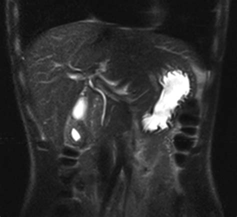 Mr Imaging Of The Gallbladder Adenomyomatosis Eurorad