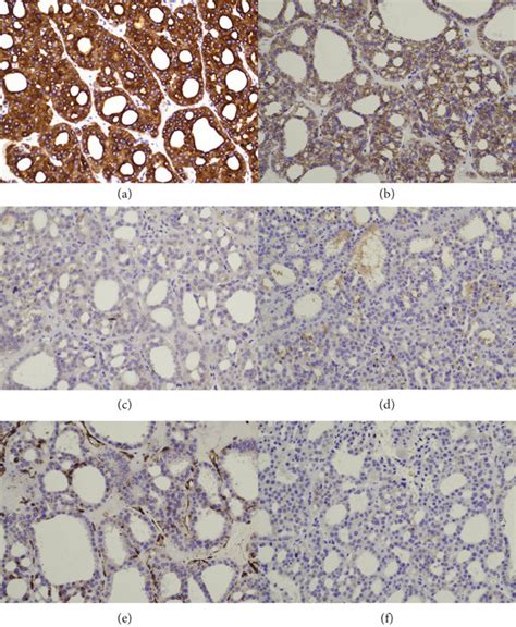 A Ck7 Diffuse And Densely Positive B E Cadherin Diffusely Download Scientific Diagram