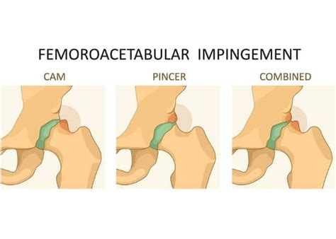Pisiform Impingement Syndrome Cause Symptoms Treatment