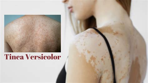Tinea Versicolor A Frequently Encountered Fungal Skin Condition