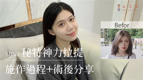 【埋線拉提】埋線會不會痛 中下臉下垂急救 不靠修圖輕鬆擁有小v臉 微整美型專家 洪睿醫師 金芝妍醫美診所 埋線拉提 埋線