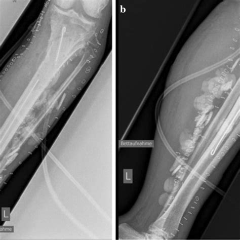 X Rays At First Admission Ao Type 41 A2 Anderson Gustilo Iiib Download Scientific Diagram
