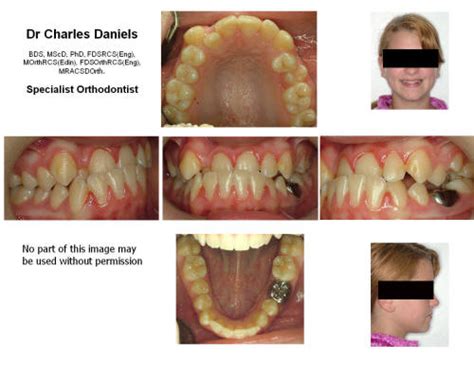 Class 3 Malocclusion