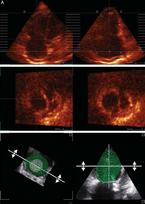 Real Time Three Dimensional Echocardiography And Cardioc Magnetic Download Scientific Diagram