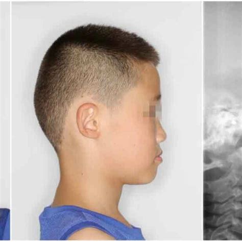 Skeletal Class Iii Malocclusion Patient Before Treatment Download