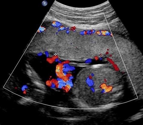 Umbilical Cord Abnormalities Pacs