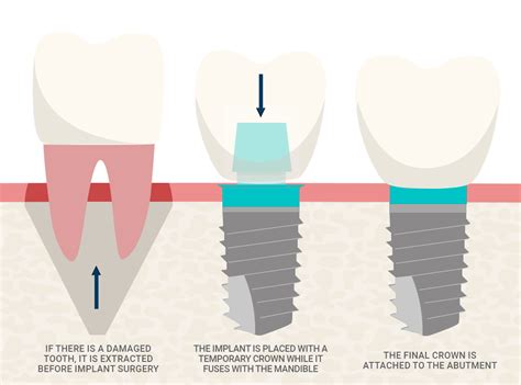 How Do Dental Implants Work Access Dental Clinics