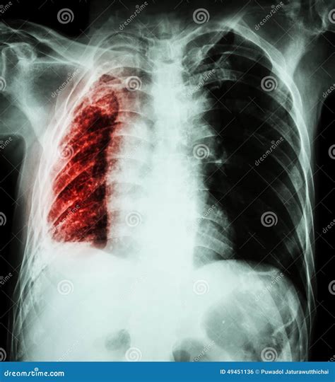 Pulmonary Tuberculosis Chest X Ray Right Lung Atelectasis And Infiltration And Effusion Due