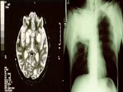 Yeasts Of Medical Importance Candida And Cryptococcus Ppt