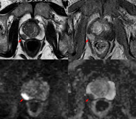 Prostate Cancer Extraprostatic Extension Image