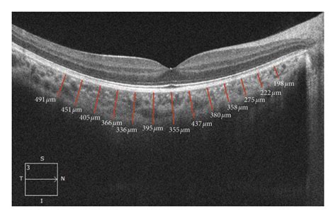 Subfoveal Choroidal Thickness In Myopia An Oct‐based Study In Young