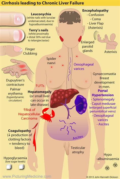 Alcoholic Liver Cirrhosis Symptoms Causes Diagnosis Qzuw