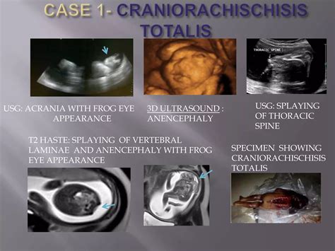 Neural Tube Defects A Case Series Copy Pptx