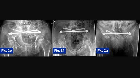 Fragility Fractures Of The Pelvis Ffp Diagnosis Classification