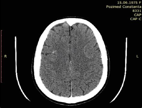 Contrast Enhanced Braincomputed Tomography Showing Dot And Ring Like Download Scientific