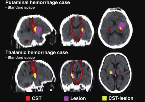 Corticospinal Tract Cst Red Lesion Mask Purple And The Overlap