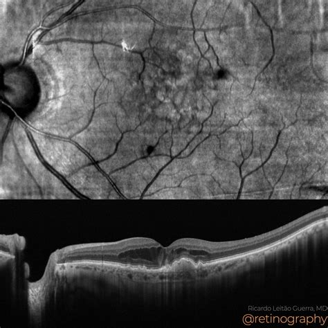 Type 3 Macular Neovascularization Retinography