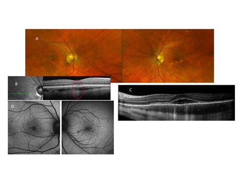 White Dot Syndromes Series Part 3 Punctate Inner Choroidopathy Optometry Advisor