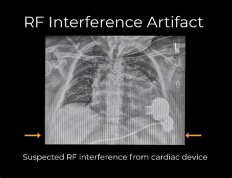 Rf Interference Case 1 Sybil Digital Learning