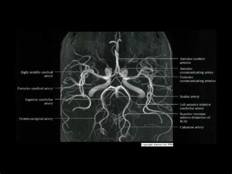 Intracranial Arteries