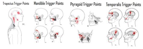 Trigger Point Treatment Of TMJ Moyer Total Wellness