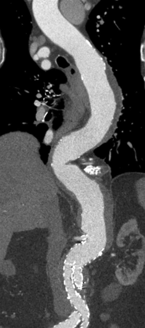Coronal Image Of Computed Tomography Angiography Cta Showing