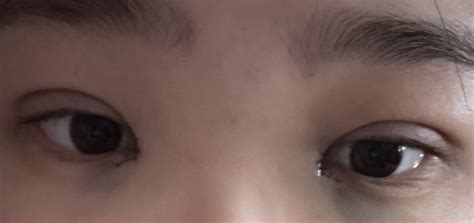 눈매교정 자연유착 앞트임 윗트임 후기 리얼후기 눈이 예쁘다 그래서 아몬드성형외과