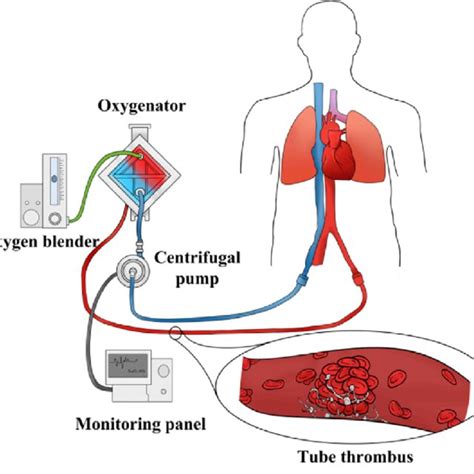 Extracorporeal Membrane Oxygenation Ecmo Is Composed Of Five Parts A Download Scientific