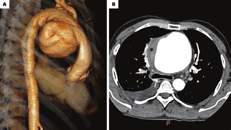 Contrast Enhanced Computed Tomography Of The Thorax A Computed Download Scientific Diagram