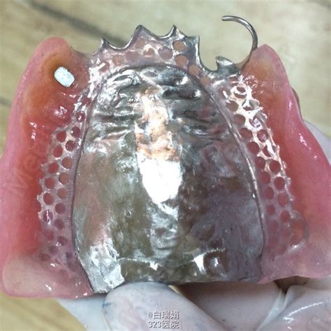 活动义齿根面磁性附着体病例 医联