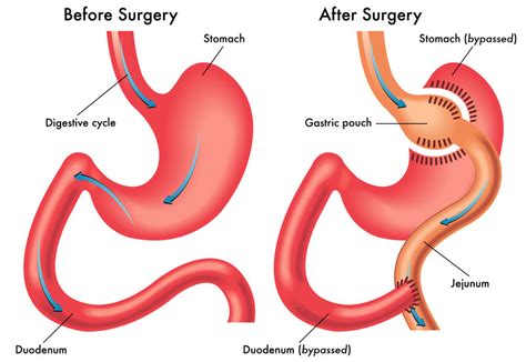 Gastric Bypass Atiya Clinic