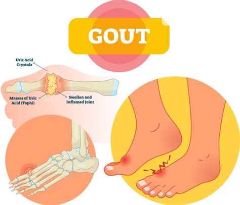Gout Arthritis Infographic Royalty Free Vector Image