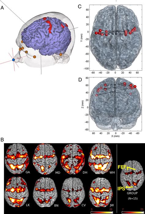 A 3 Dimensional 3d Rendering Of The Skin And Segmented Gray Matter