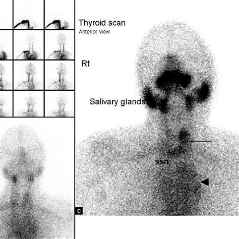 Pdf Primary Intrathoracic Goiter Incidental Diagnosis On 99m Tc Pertechnetate Radioisotope